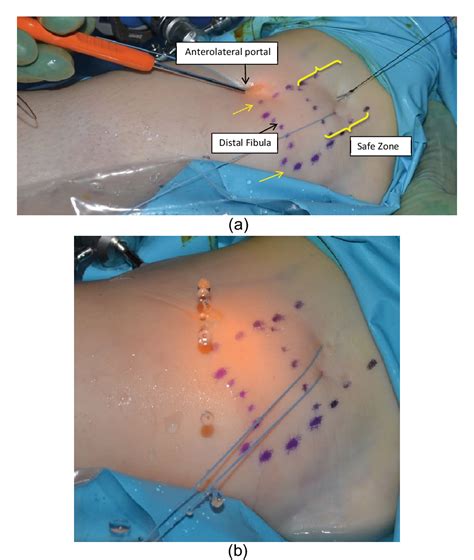 Figure 3 From Arthroscopic Brostrom Technique Semantic Scholar