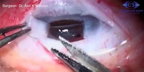 Spotting The Schwalbe Line An Intraoperative View In Axenfeld Rieger