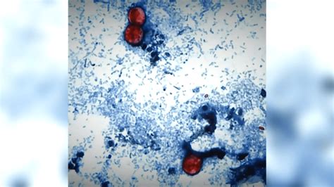 Nyc Cyclosporiasis Update Numbers Climb Cdc Issues New Alert Nbc