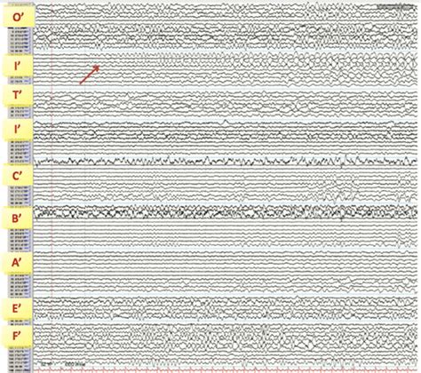 Seeg Ictal Recordings A Seeg Recordings Showing Ictal Onset In