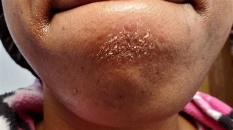 Glycolic Peel Burn Treatment At Rose Perez Blog