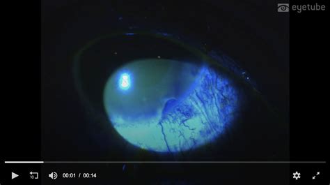 Paracentesis Eye Escrs In The Know—iris Repair Part 3