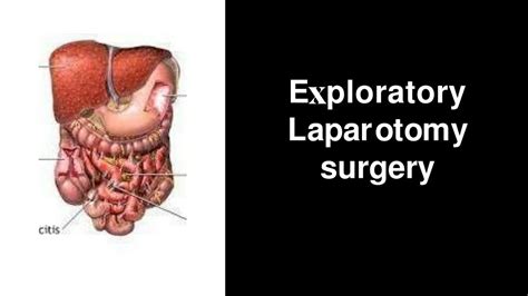 Ppt Exploratory Laparotomy Surgery Powerpoint Presentation Free
