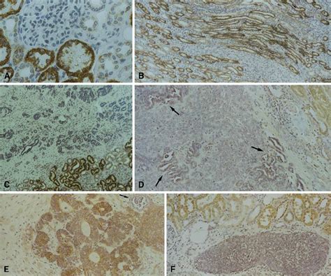 Immunohistochemical Findings Immunoperoxidase Staining Dab