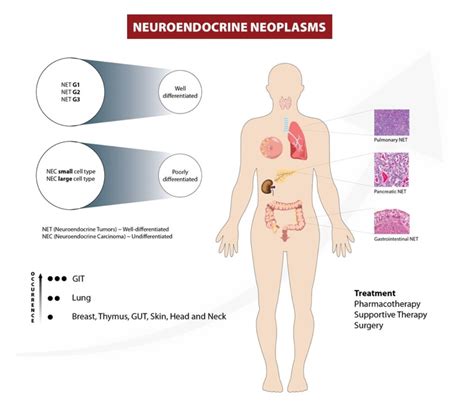 Carcinoid Syndrome Rash