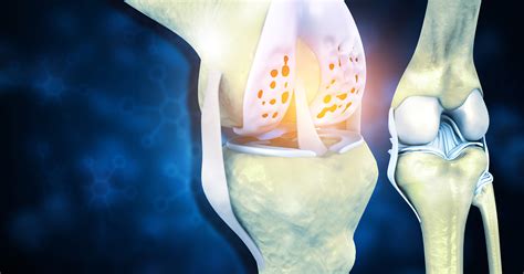 Cartilage Restoration Techniques New Hope For Early Arthritis