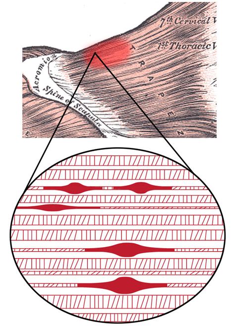 Trigger Points What Are They