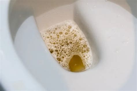 Cloudy Urine Causes Symptoms And What It Says About Your Health