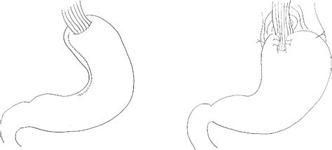 Figure 2 From Proximal Gastrectomy For Gastric Cancer Semantic Scholar