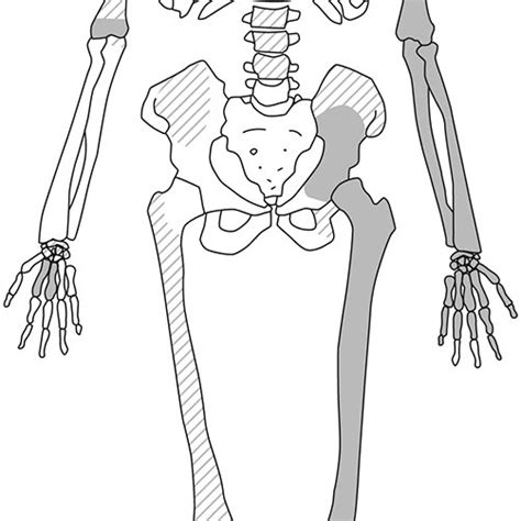 Fragment Of The Left Condyloid Process Of A Mandible Showing A Bony