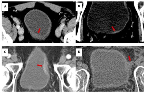 Visualization Of Intraluminal Bladder Mass By Time Before Pathologic