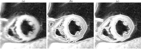 figure 4 from a hybrid level set segmentation for medical imagery