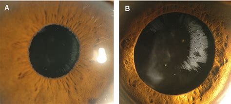 Figure 1 From Pseudoexfoliative Material On The Iol Surface And