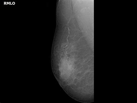 Atlas Of Breast Cancer Early Detection