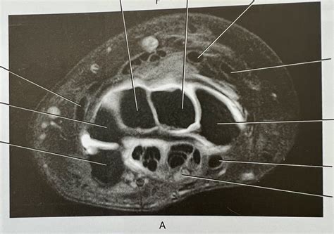 Axial T1 Wrist Post Arthrogram Diagram Quizlet