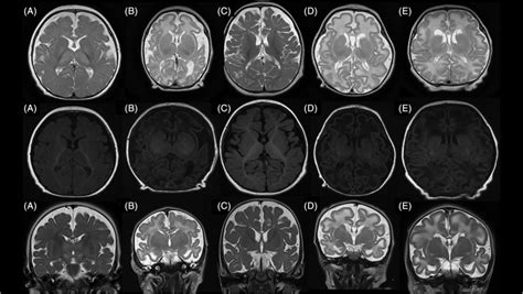 Brain Mri Features First Row Axial T2 Sequence Second Row Axial T1