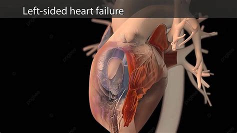 Illustration Congestive Heart Failure Equipment Copd Modern Photo