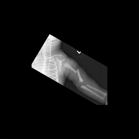 Pediatric Proximal Humerus Fracture Pediatric Radiology Reference