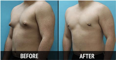 Is Gynecomastia Surgery Safe Redefine