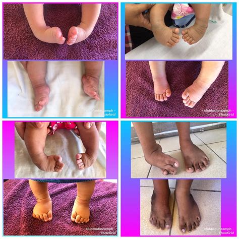 In Pinays Footsteps Clubfoot In The Philippines 2018 Hand In Hand