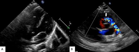 A B Long Axis And Modified Short Axis Transthoracic Download Scientific Diagram