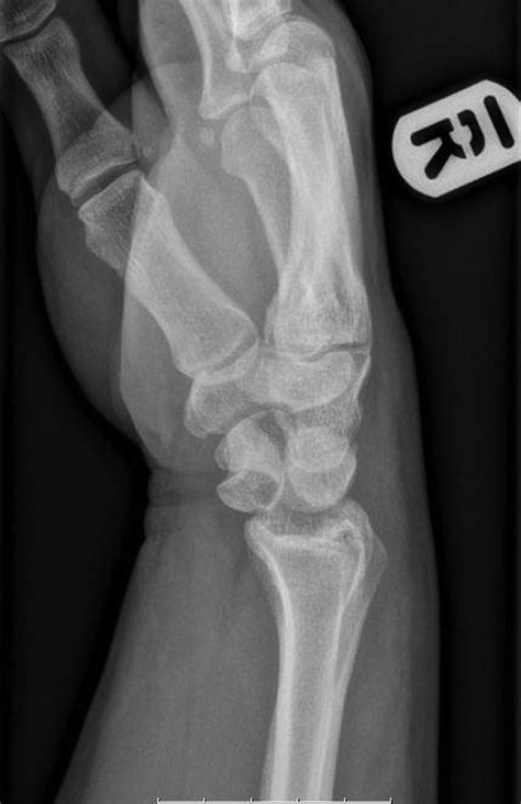 Radiological Signs Of A True Lunate Dislocation Bmj Case Reports