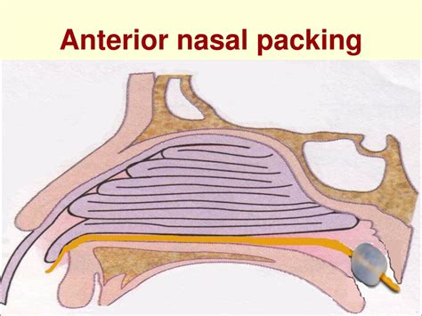 Ppt Epistaxis Powerpoint Presentation Free Download Id1364903
