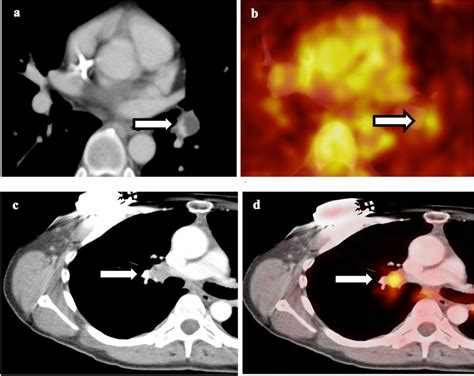Comparison Between Pulmonary Embolism And Perihilar Lymph Node A