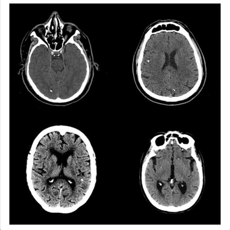 A Ct Scan Showing A Single Calcification Black Arrow Highly Download Scientific Diagram