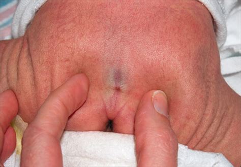 Sacral Dimple Causes Newborn Adults Ultrasound And Management
