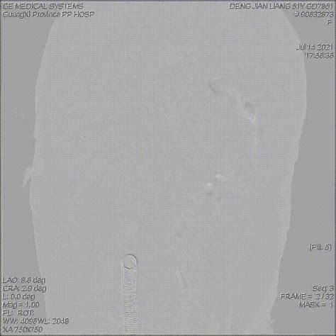 中枢介入第358期：双发动脉瘤适配不同支架辅助治疗 脑医汇 神外资讯 神介资讯