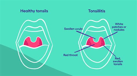 White Spots On Tonsils After Antibiotics