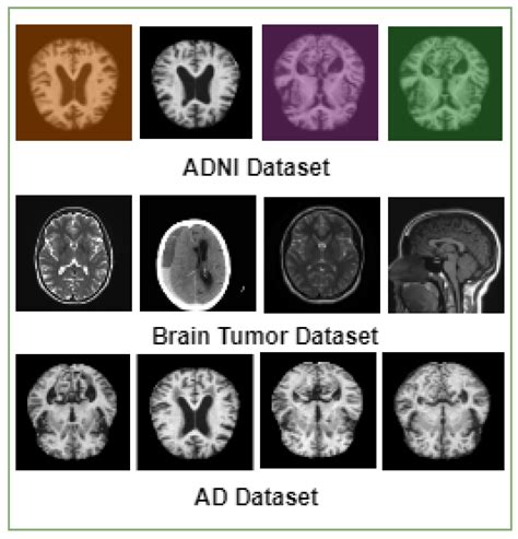 Ai Free Full Text Improving Alzheimers Disease And Brain Tumor