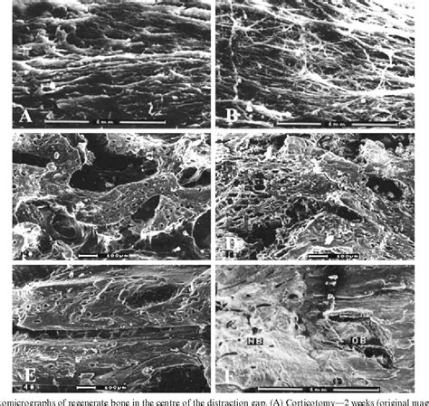Figure 1 From Differences In Mandibular Distraction Osteogenesis After