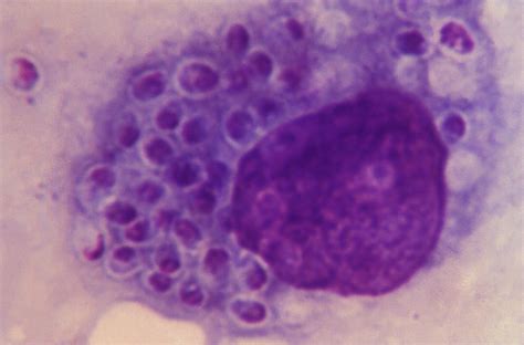 Histoplasmosis Macrophage Histoplasmosis