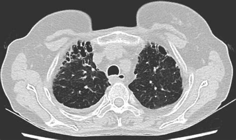 A 58 Year Old Woman With Systemic Sclerosis Axial Chest Computed