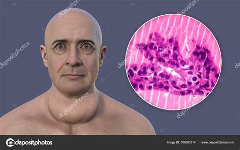 Illustration Man Enlarged Thyroid Gland Exophthalmos Alongside