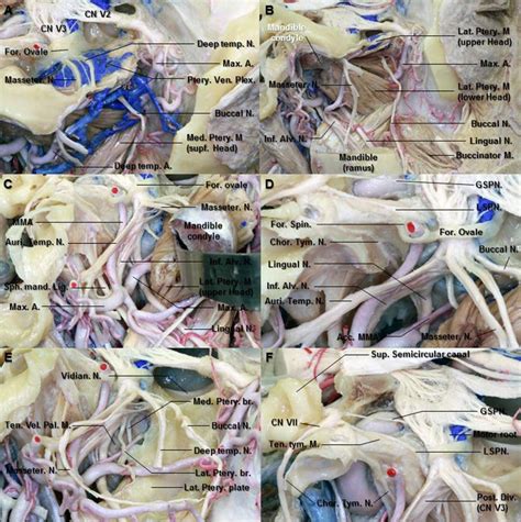 Dissection Of The Right Infratemporal Fossa Neuroanatomy The Neurosurgical Atlas