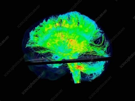 Brain Tumour DTI MRI Scan Stock Video Clip K Science Photo Library