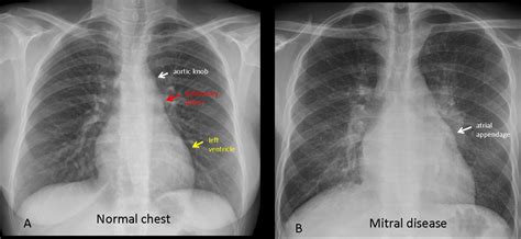 Pulmonary Artery X Ray