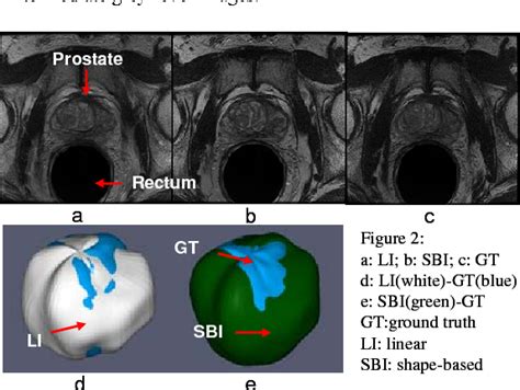 Figure 2 From Shape Based Interpolation Of Mri Volumes In Trus Fusion Based Biopsy Semantic