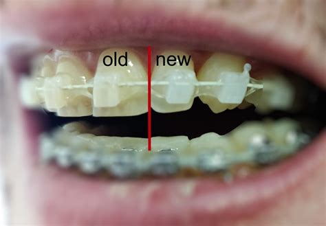 Do Clear Braces Turn Yellow Real Results Quick Fixes For Ceramic