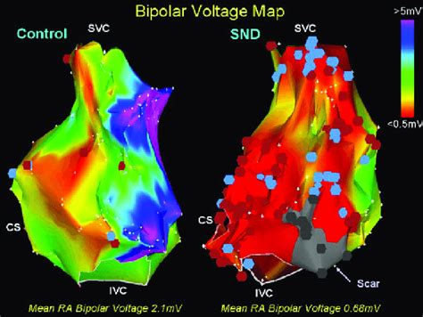 Electroanatomic Bipolar Voltage Mapping Of The Right Atrium In A
