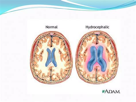 Hydrocephalus Pptx