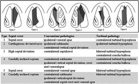 Nasal Septum Deviation