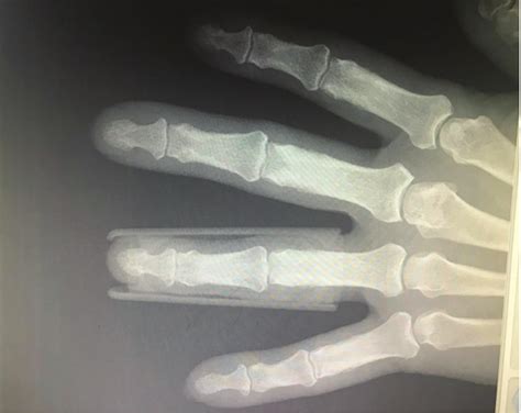 X Ray After Use Of Splint Produced With 3d Download Scientific Diagram