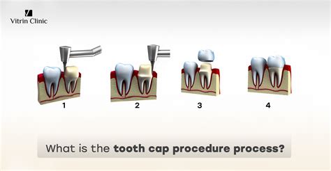 What Are The 7 Key Steps Of A Successful Tooth Cap Procedure In 2026