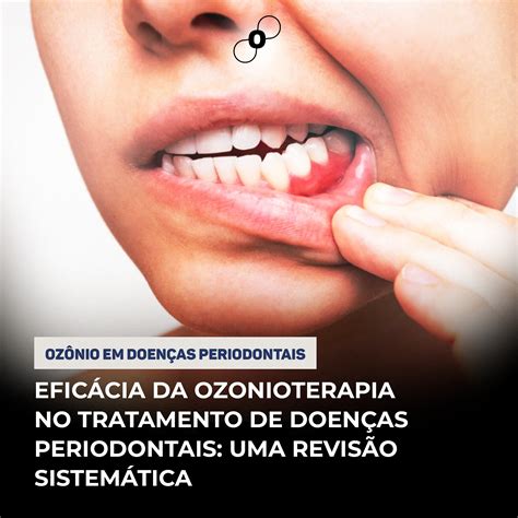 Ozoxx Você Sabia Que O Ozônio Pode Ser Um Elemento Facilitador Em Tratamentos Contra Doenças