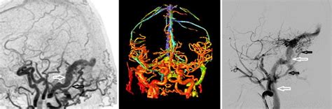 Dural Arteriovenous Fistula Davf Located In The Right Sigmoid Sinus