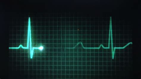 Animation Of Schematic Diagram Of Normal Sinus Rhythm For A Human Heart